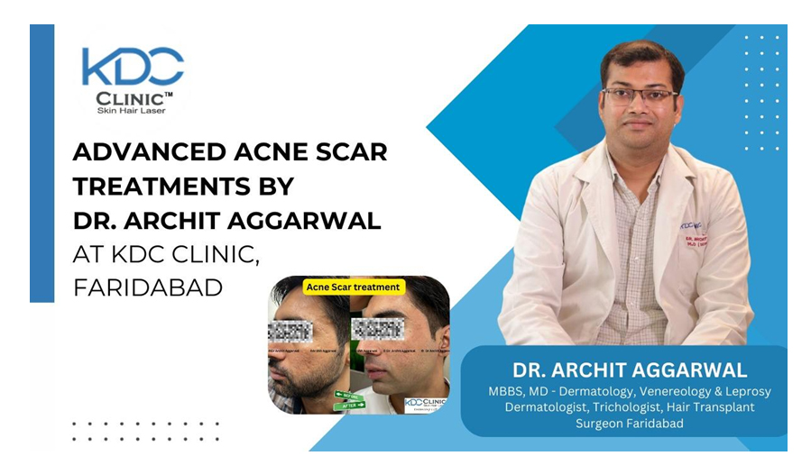 Advanced Acne Scar Treatments by Dr. Archit Aggarwal at KDC Clinic ...